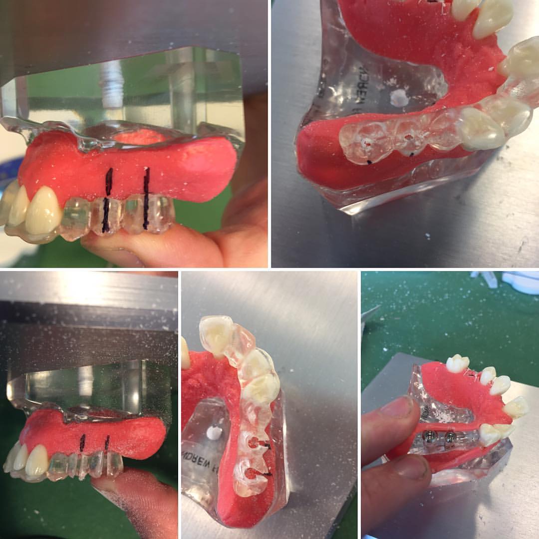 Implant Surgical Guide – Dental Implants Hereford